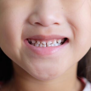 Chipped Teeth Are Common - Best Dentist Near You - Partha