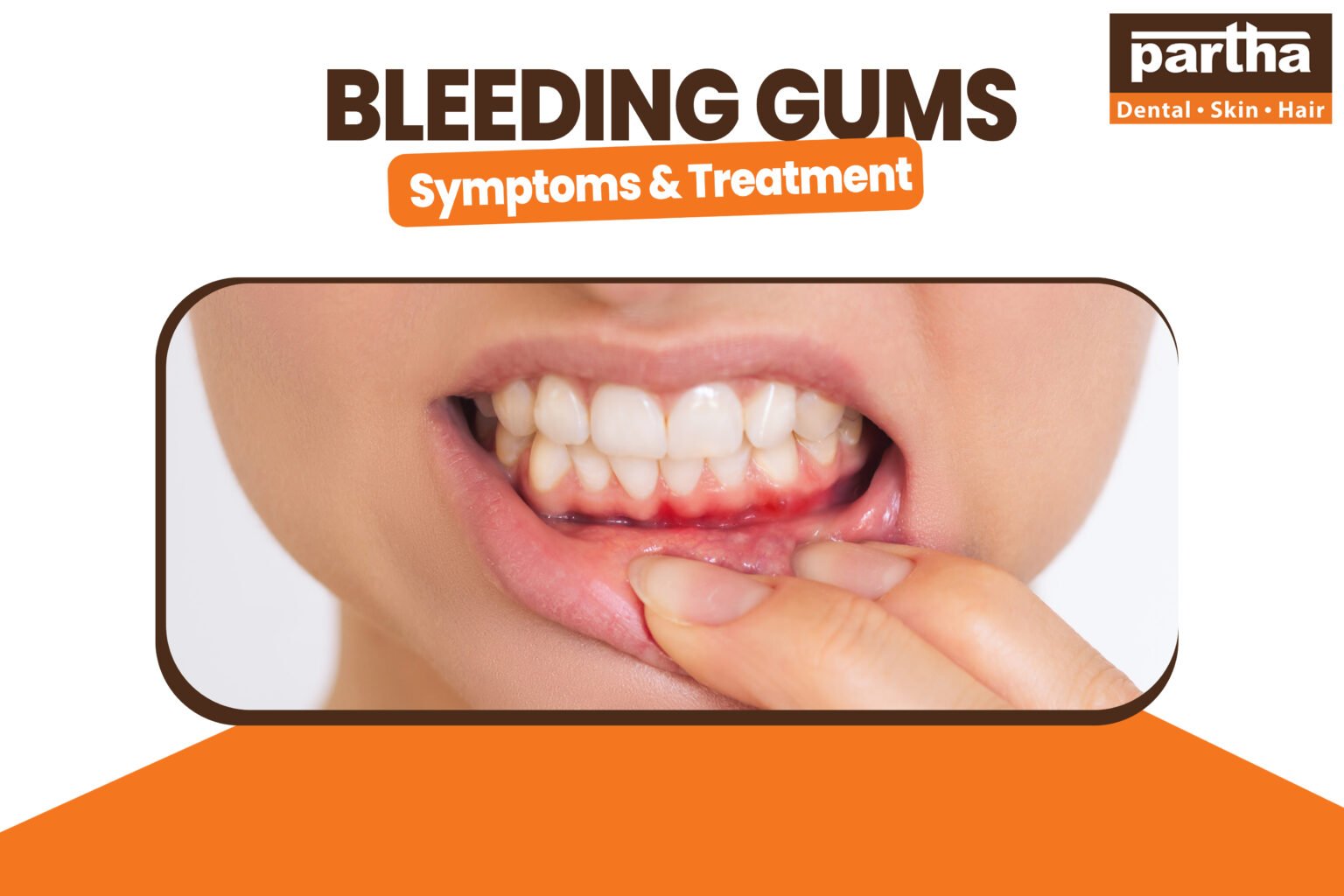 Bleeding Gums – Symptoms, Causes, Treatment And Home Remedies