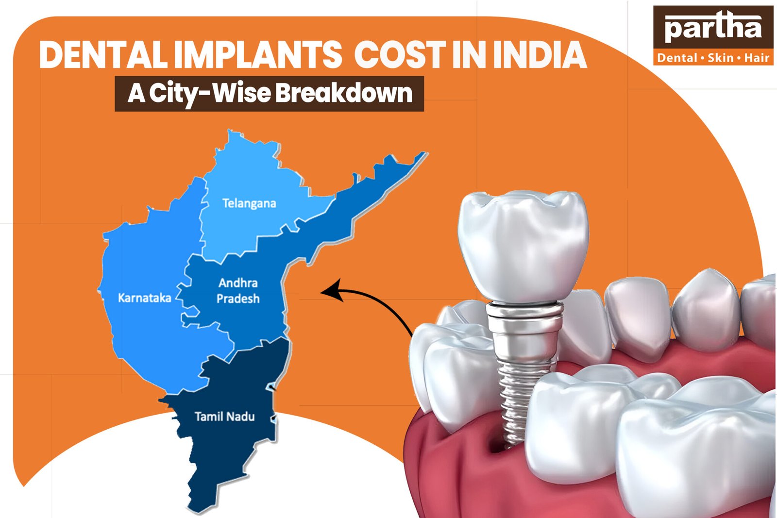 Dental Implants Cost In India – A City-Wise Breakdown