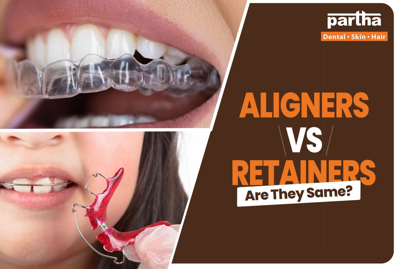 All-on-4 Dental Implants Cost In Chennai | Price & Benefits