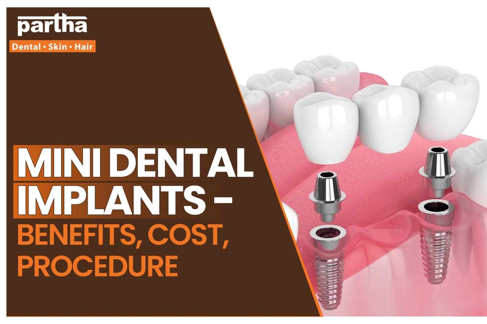 Mini Dental Implants - Benefits, Cost, Eligibility, Procedure, Recovery