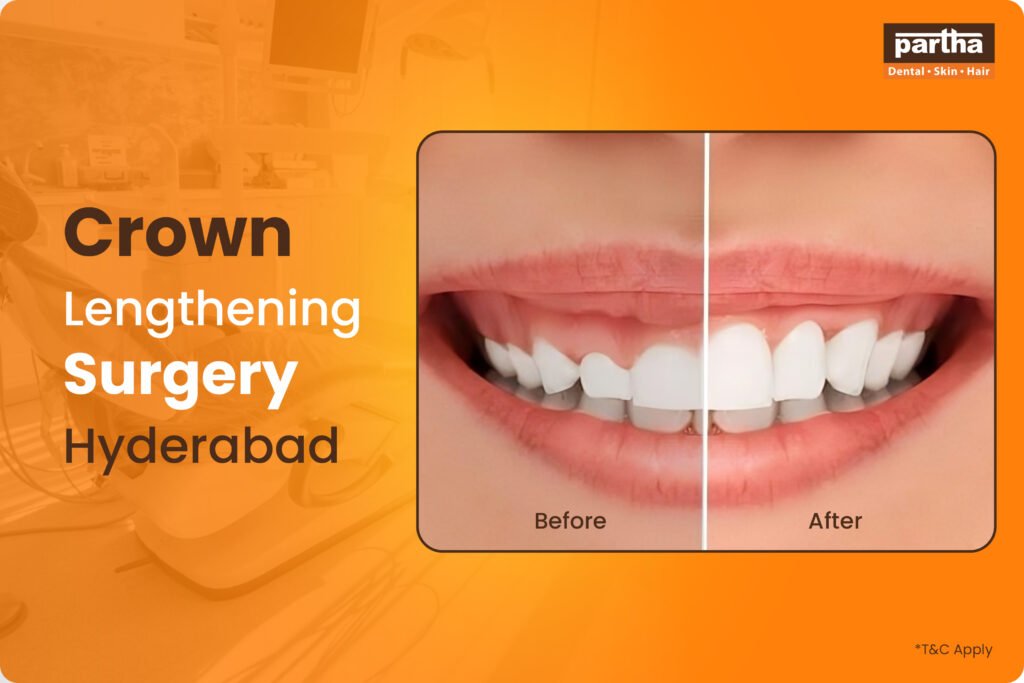 Crown Lengthening Surgery Cost In Hyderabad | Expert Care