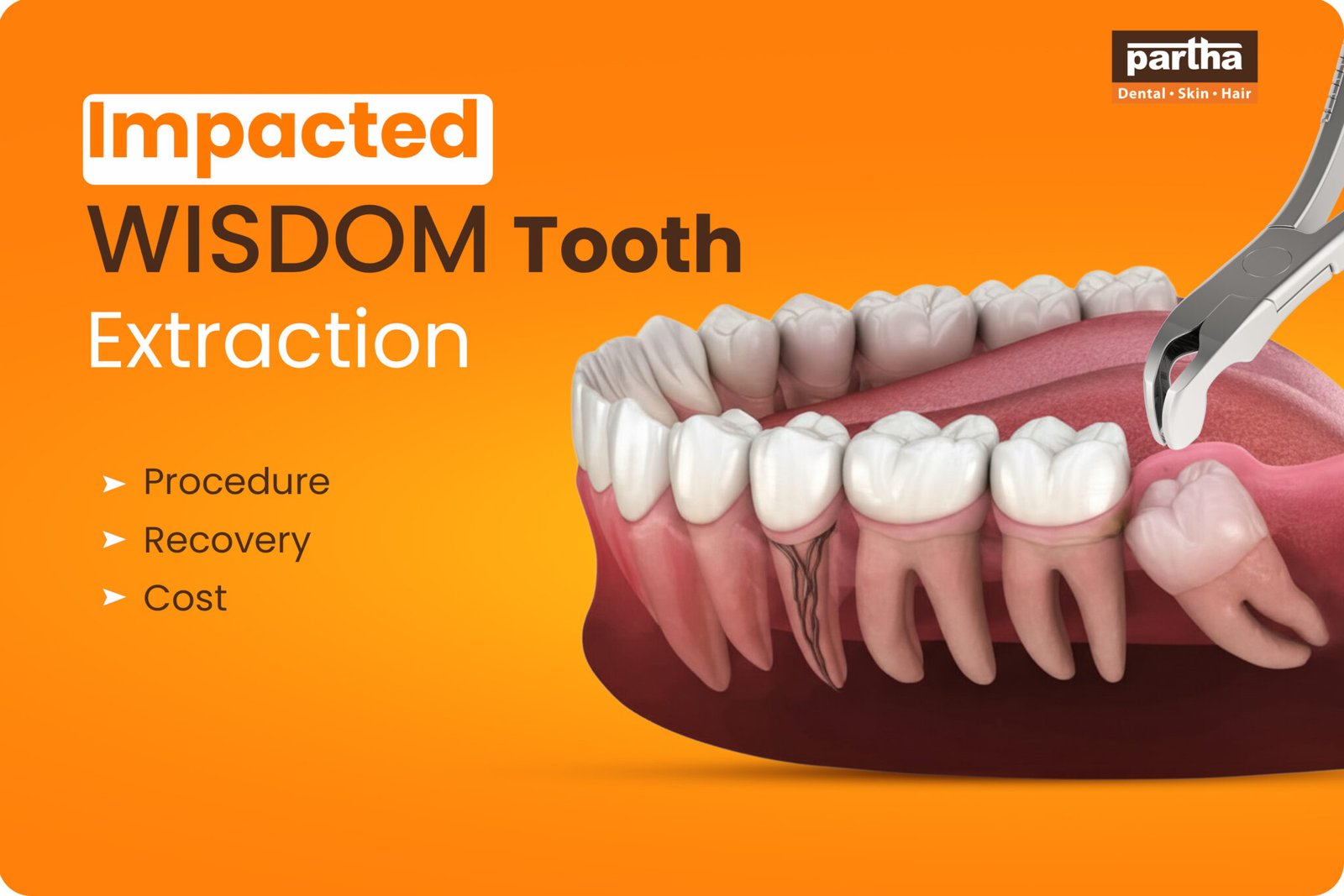 Impacted Wisdom Tooth Extraction – Procedure, Cost, Recovery