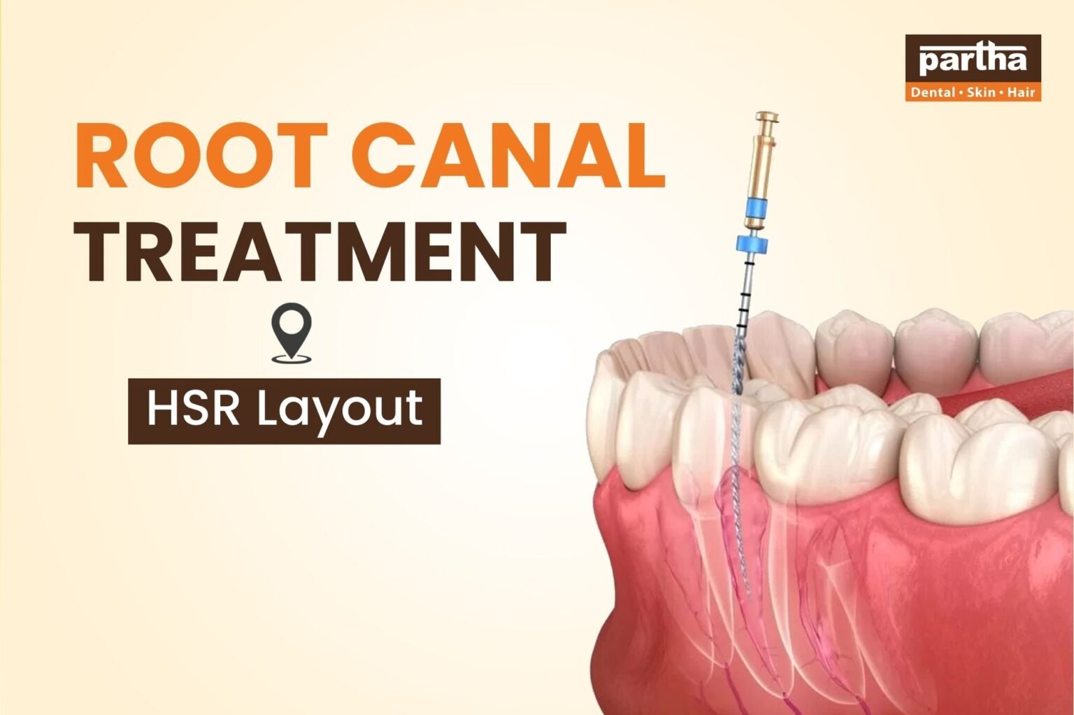 Painless Root Canal Treatment In HSR Layout | Partha Dental