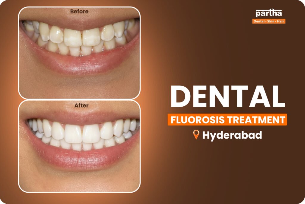 Dental Fluorosis Treatment In Hyderabad | Causes & Cost Guide