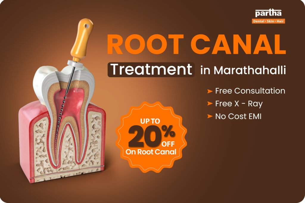 Root Canal Treatment In Marathahalli – Partha Dental