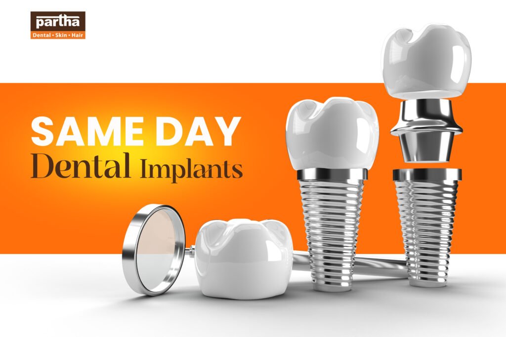 Same Day Dental Implants In India | Quick Smile Fix
