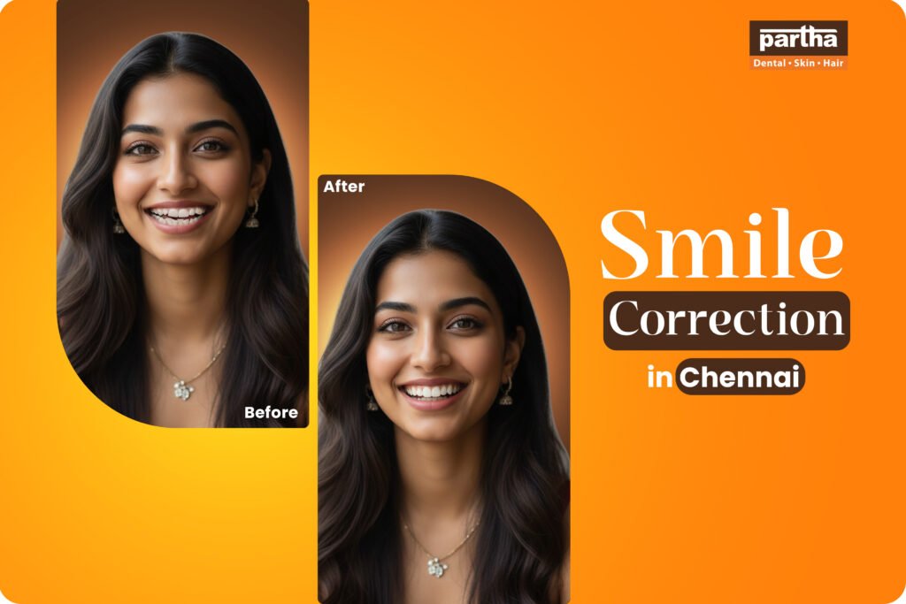 Best Smile Correction Treatment In Chennai | Perfect Smile