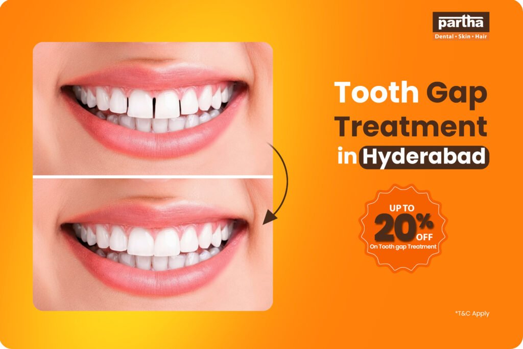 Teeth Gap Treatment In Hyderabad – Your Smile’s New Best Friend