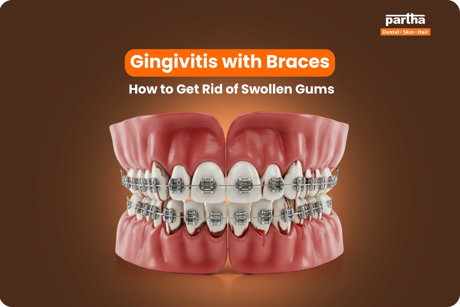 Braces & Gingivitis | How To Treat Swollen Gums Effectively