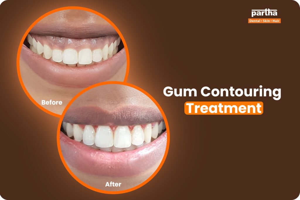 Gum Contouring Treatment | Gummy Smile Correction – Cost, Procedure