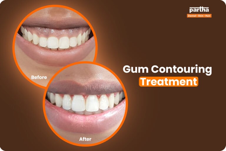 Gum Contouring Treatment Gummy Smile Correction Cost Procedure