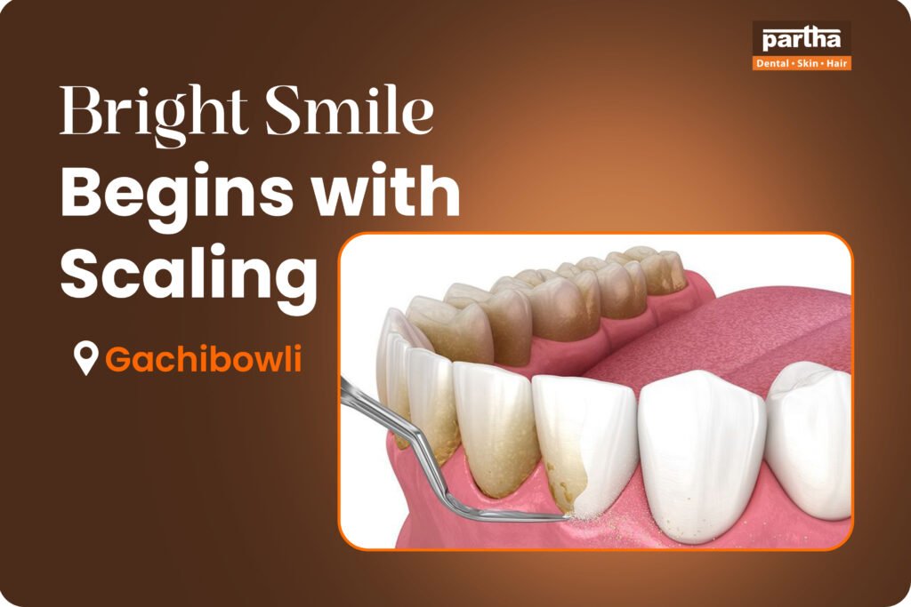Dental Scaling In Gachibowli | Healthy & Brighter Smile Care