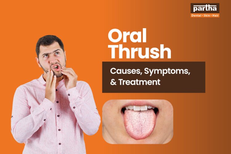 Oral Thrush: Causes, Symptoms, & Treatment