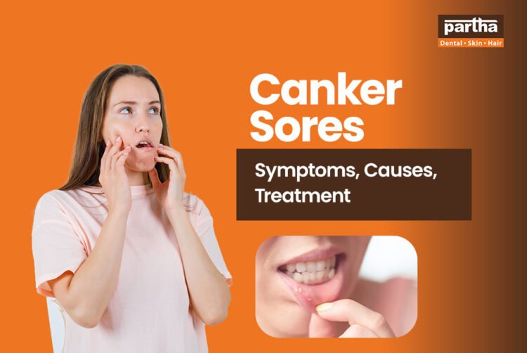 Canker Sores - Symptoms, Causes, Treatment